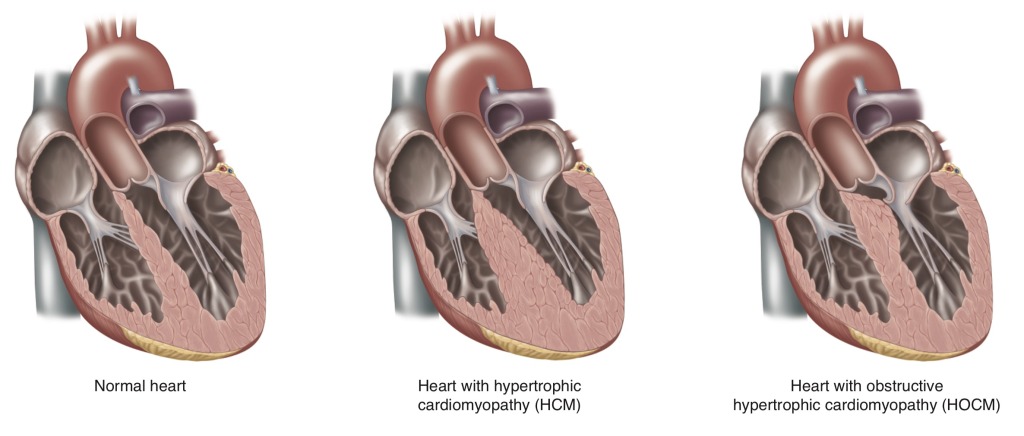 HCM vs HOCM vs Normal Heart - Hypertrophic Cardiomyopathy Learning Center